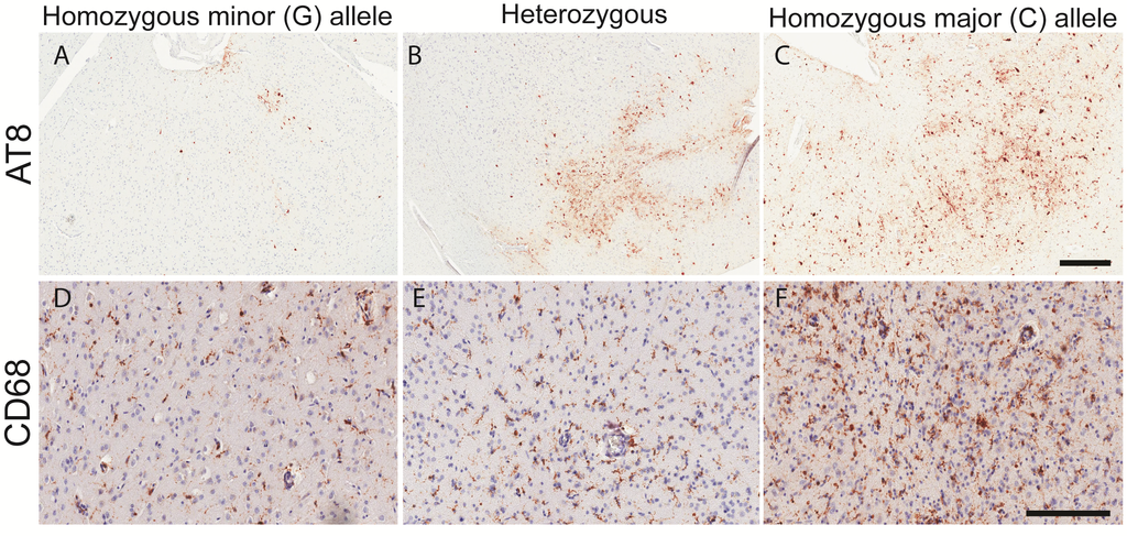 Genetic Risk Factor for CTE Detected | Chobanian & Avedisian School of ...