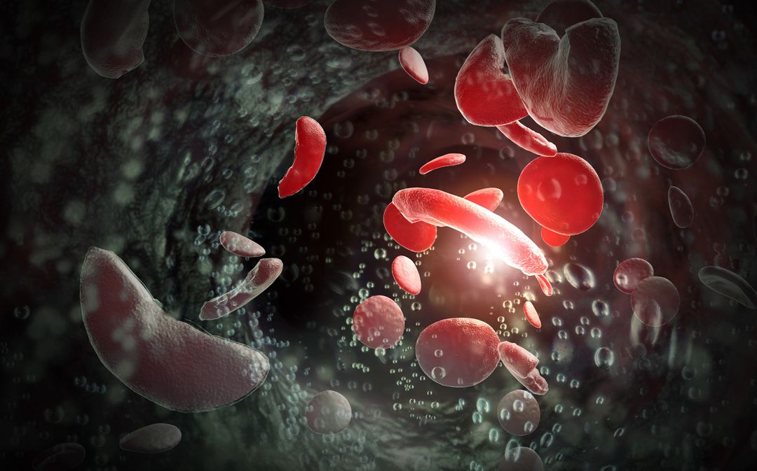 Sickle Cell Patients Who Receive Lactated Ringer’s Solution for Painful ...