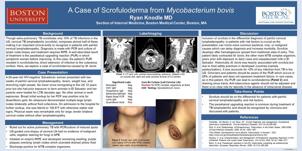 A Case of Scrofuloderma from Mycobacterium bovis | Internal Medicine ...