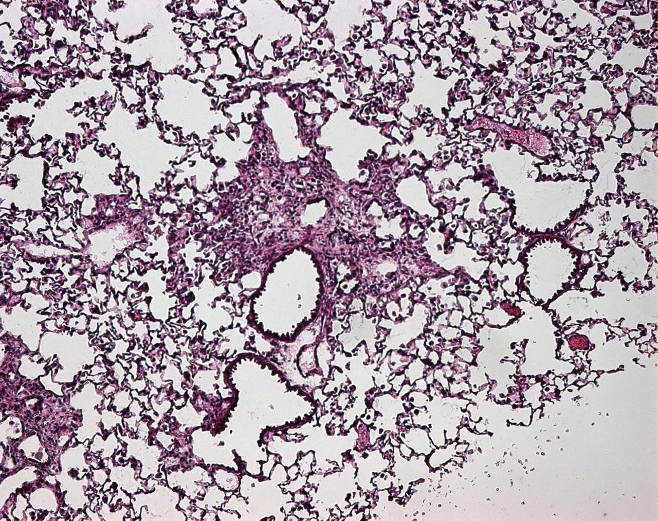 Interstitial Lung Disease (ILD) Induced Pluripotent Stem Cell (iPSC ...