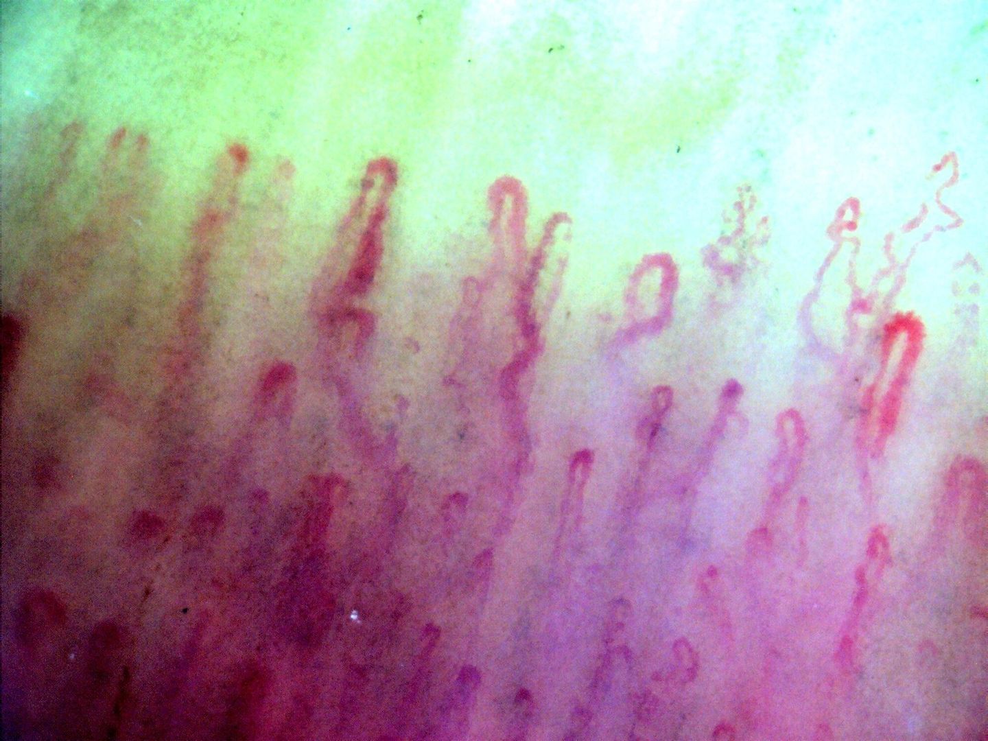 Diagnosis of Scleroderma | Rheumatology